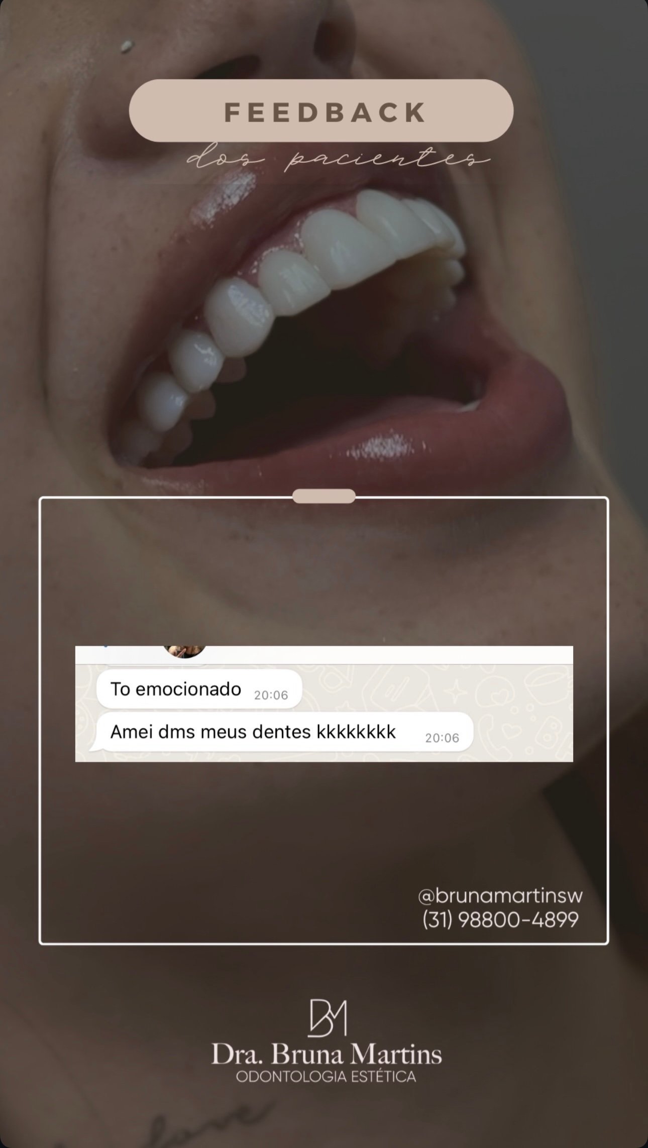 Próteses removíveis (Dentadura e Roach) - Dra. Bruna Martins