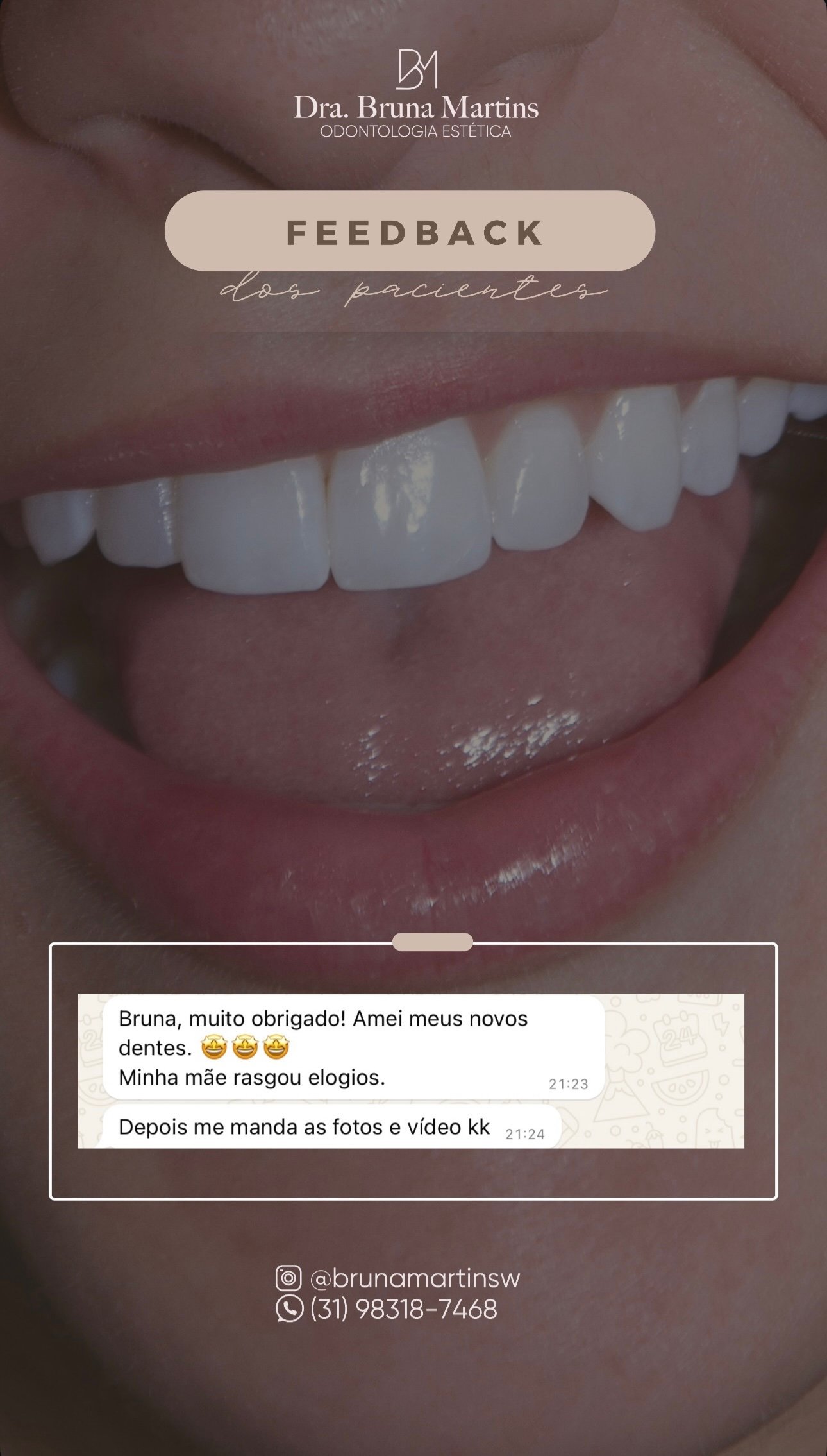 Próteses removíveis (Dentadura e Roach) - Dra. Bruna Martins