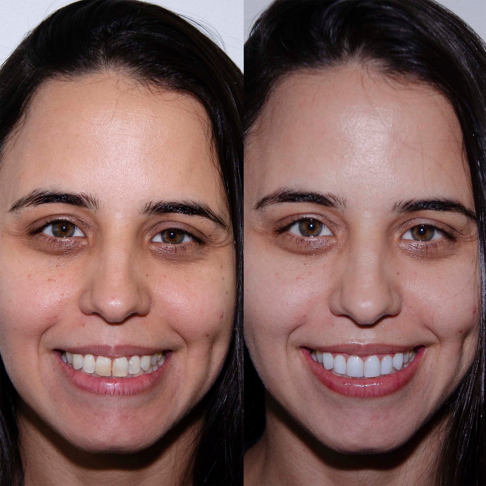 Próteses removíveis (Dentadura e Roach) - Dra. Bruna Martins