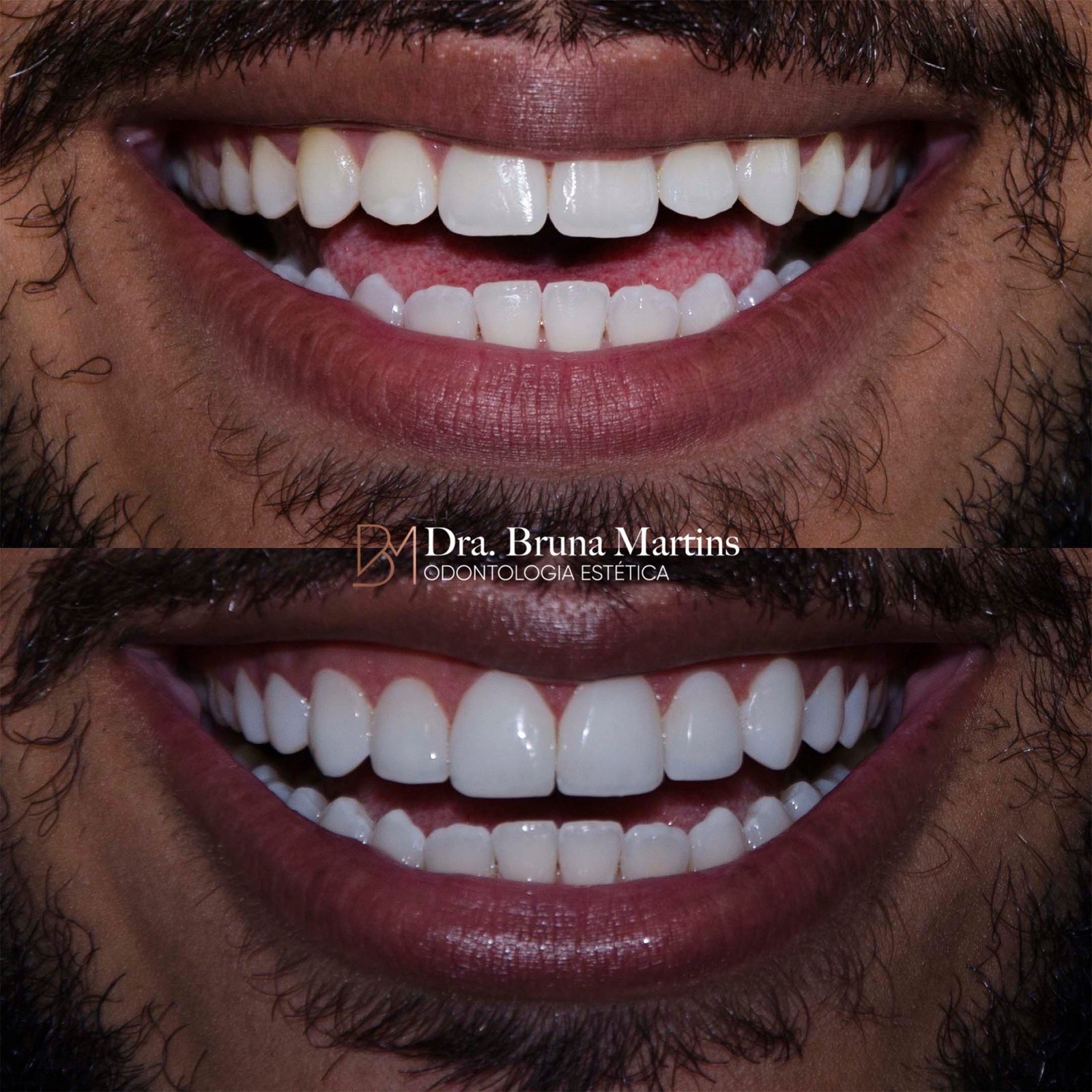 Próteses removíveis (Dentadura e Roach) - Dra. Bruna Martins