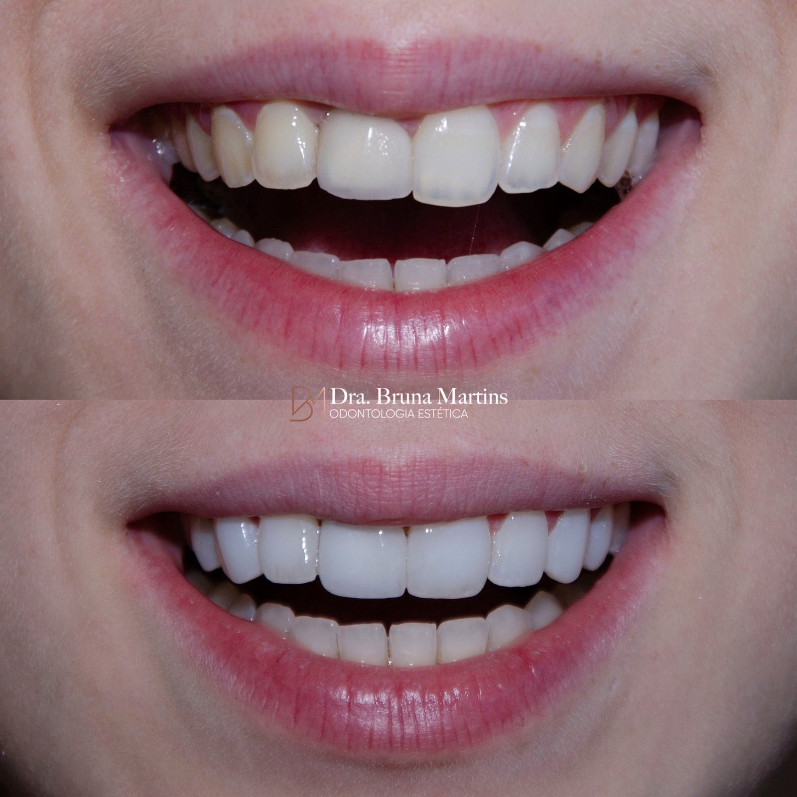 Próteses removíveis (Dentadura e Roach) - Dra. Bruna Martins